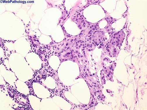 student_topics: Prostatic Adenocarcinoma slides