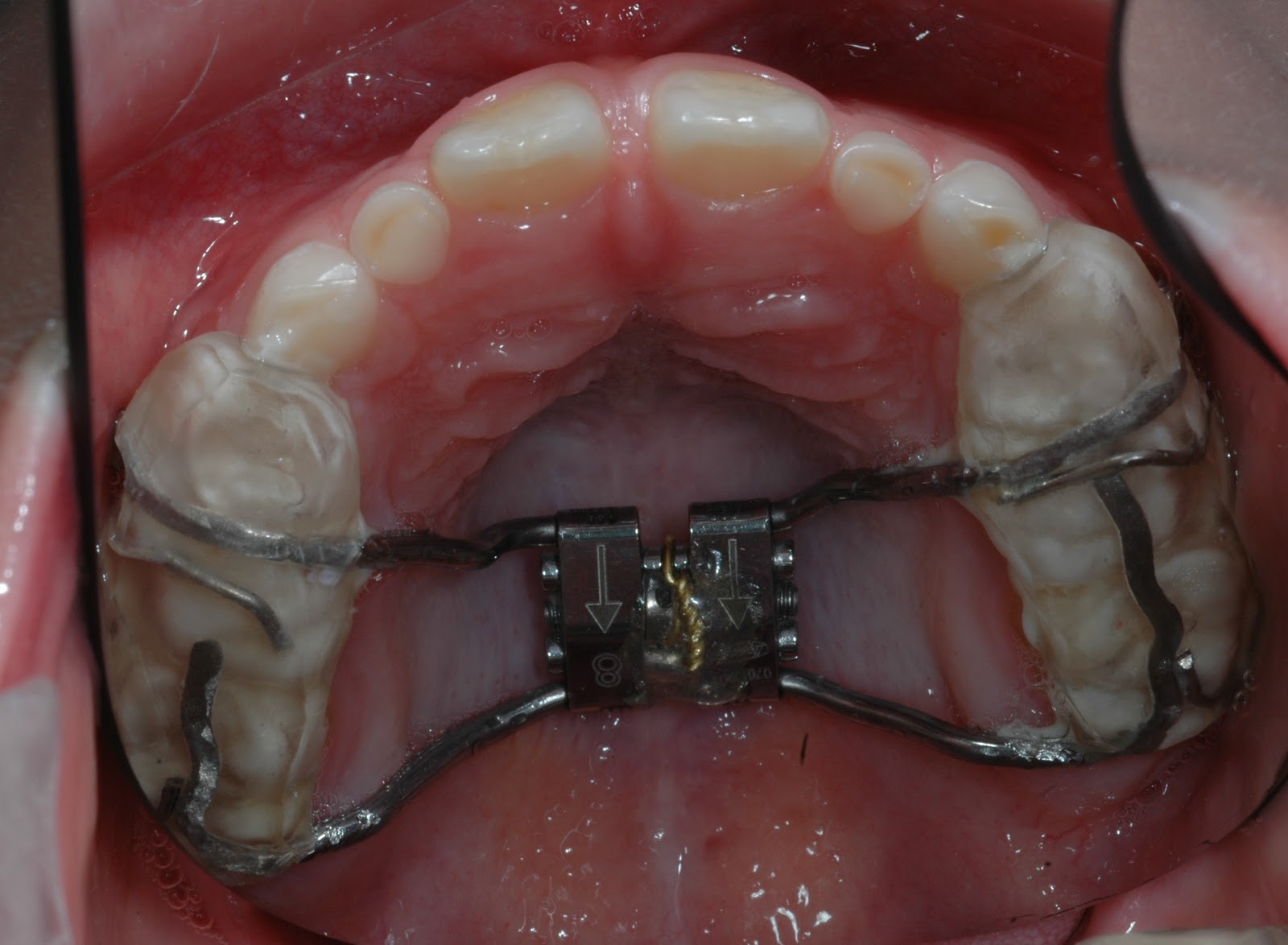 Orthodontic Corner: Bone Anchored Maxillary Protraction of Growing ...