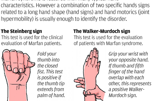 Marfan syndrome,What to know?
