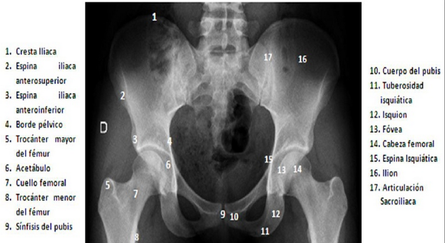 Tecnicos Radiologos Fractura De Pelvis Y De Cadera Todas Las