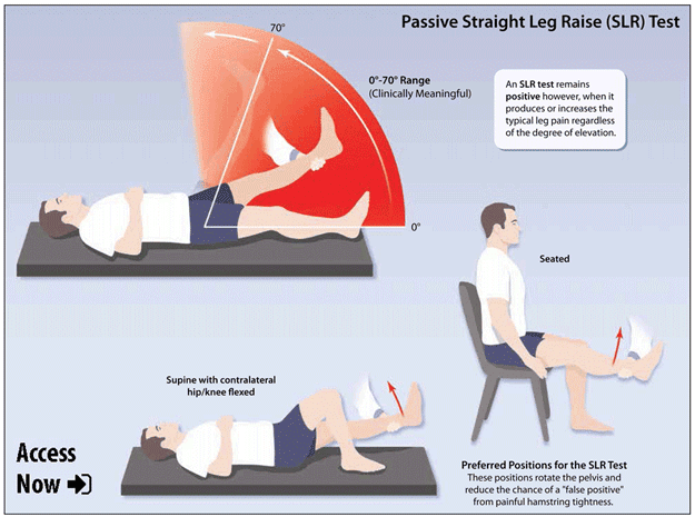 Reviews Opinions In Emergency Medicine Sciatica The Pain That