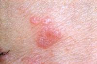 Rash Hepatitis C Lichen Planus Photos