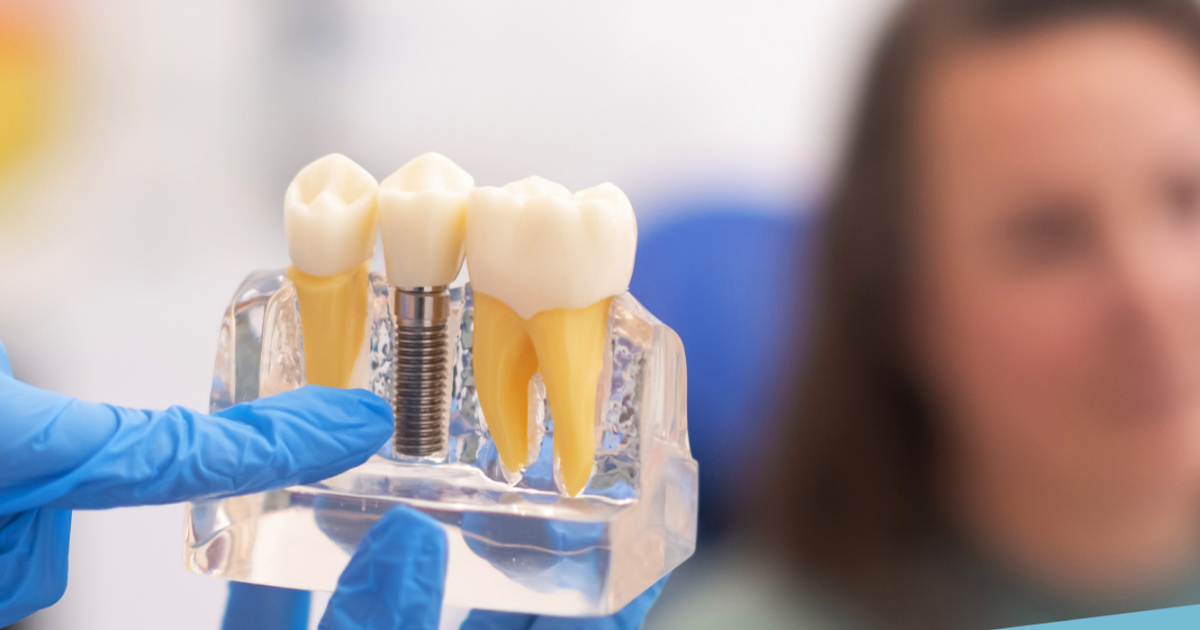 Posted on Jan 2, 2024A dental implant is a root-shaped fixture that is ...