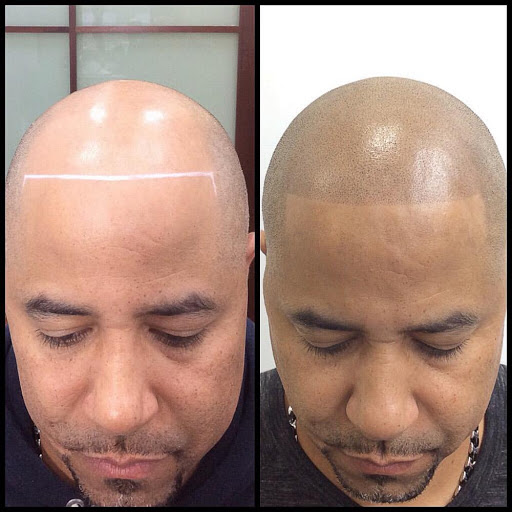New York City hairline SMP https://gerowhairink... - Gerow Hair Ink