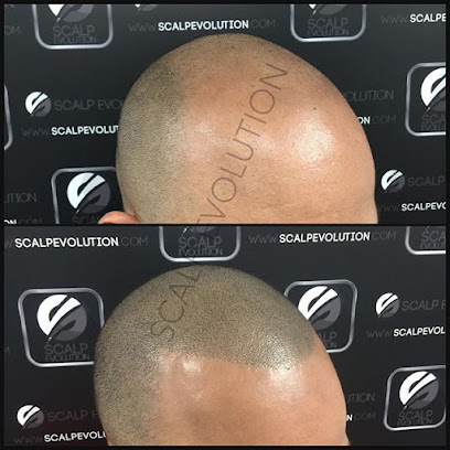 Scalp Evolution - Scalp Micropigmentation Miami SMP - Hair Clinic | MyHair